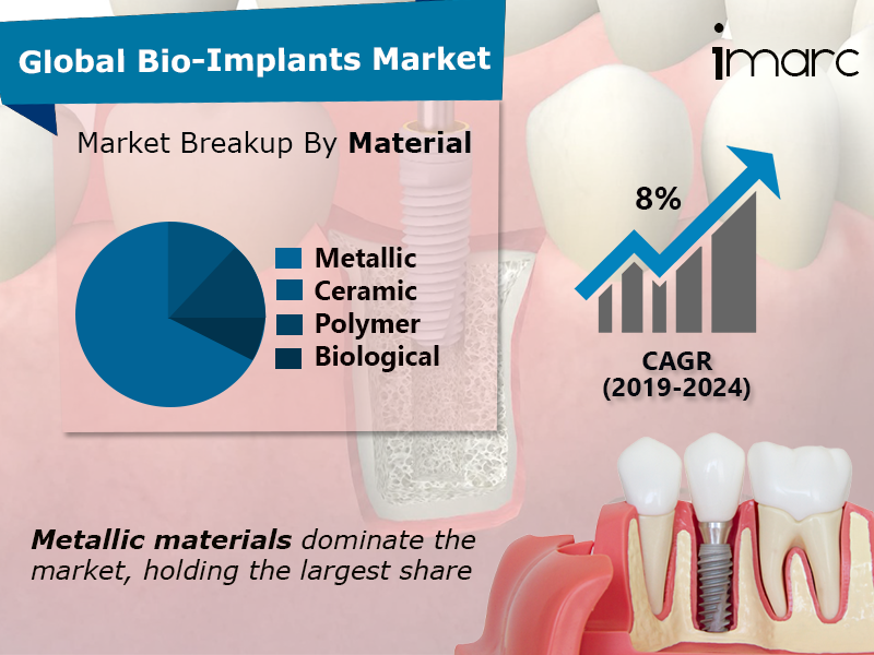 Global Bio-Implants Market to Reach US$ 136.3 Billion by 2024